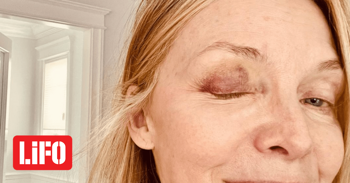 Η Μισέλ Φάιφερ εμφανίστηκε με μαυρισμένο μάτι | LiFO