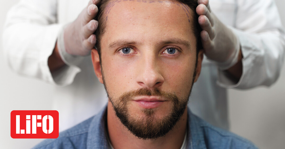 Μεταμόσχευση μαλλιών με την τεχνική FUE, για φυσικό αποτέλεσμα χωρίς τραυματισμό | LiFO