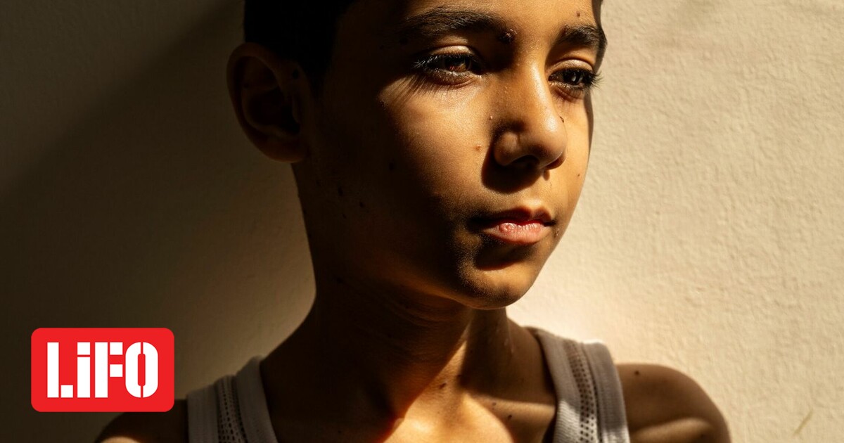 World Press Photo 2025: Πρώτο βραβείο στη φωτογραφία 9χρονου Παλαιστίνιου που ακρωτηριάστηκε | LiFO